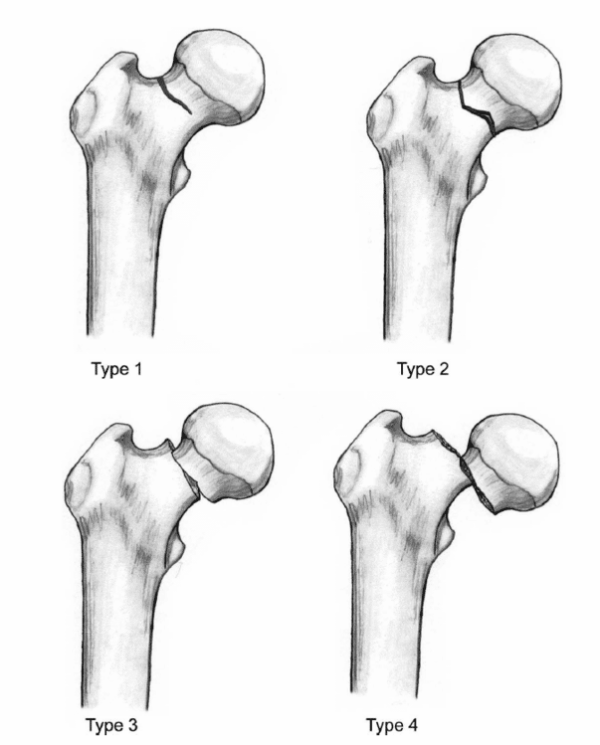 What is a Neck of Femur (NOF) fracture? Causes & consequences of NOF ...
